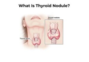 What Is Thyroid Nodule?
