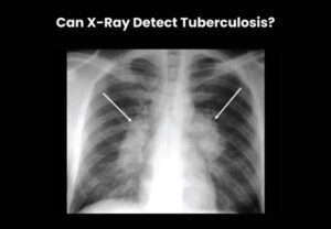 Can X-Ray Detect Tuberculosis?